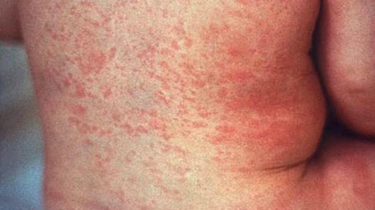 11 kinderen hebben ziekte rodehond