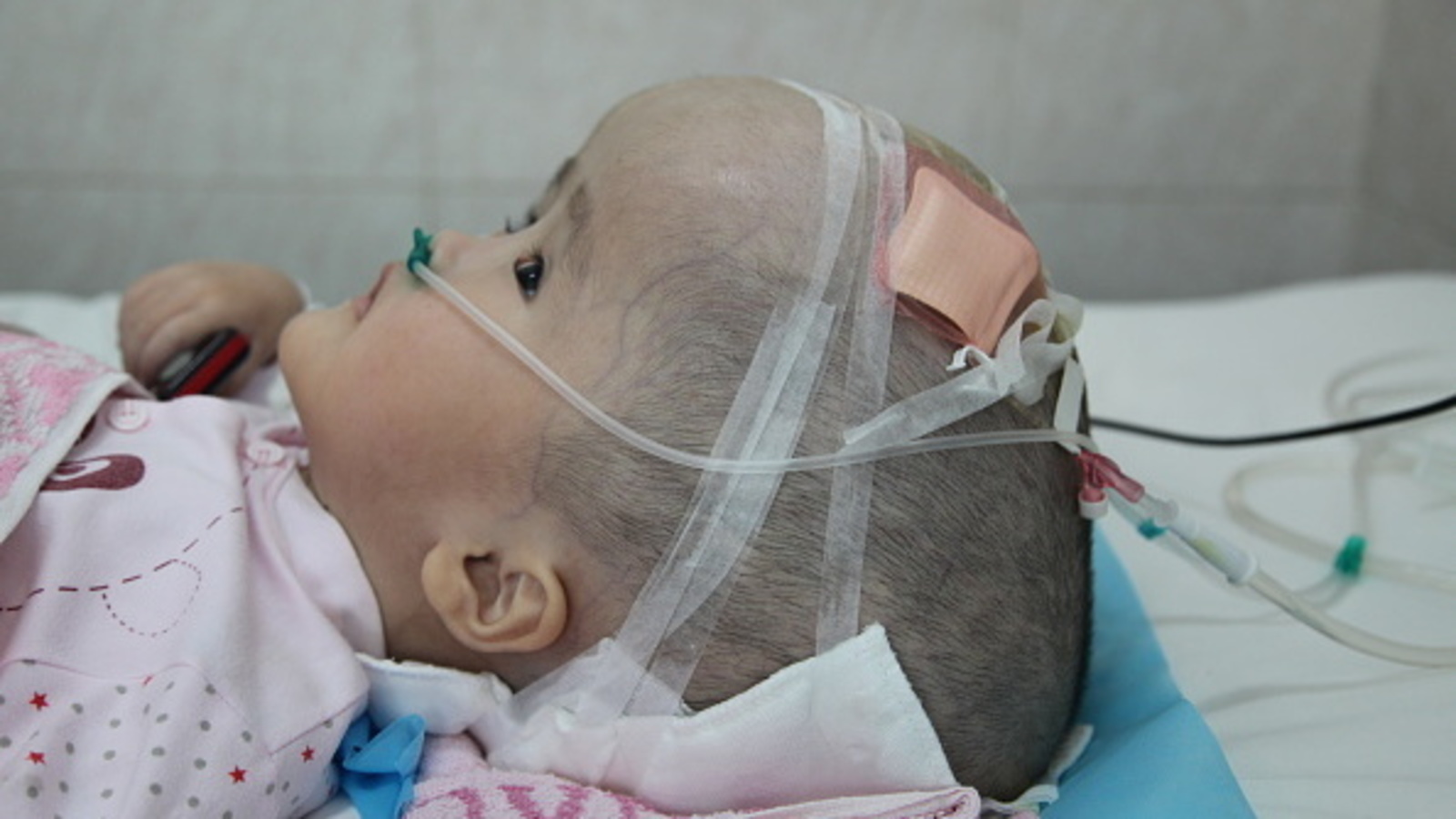 Meisje met waterhoofd krijgt 3D-schedel | NOS