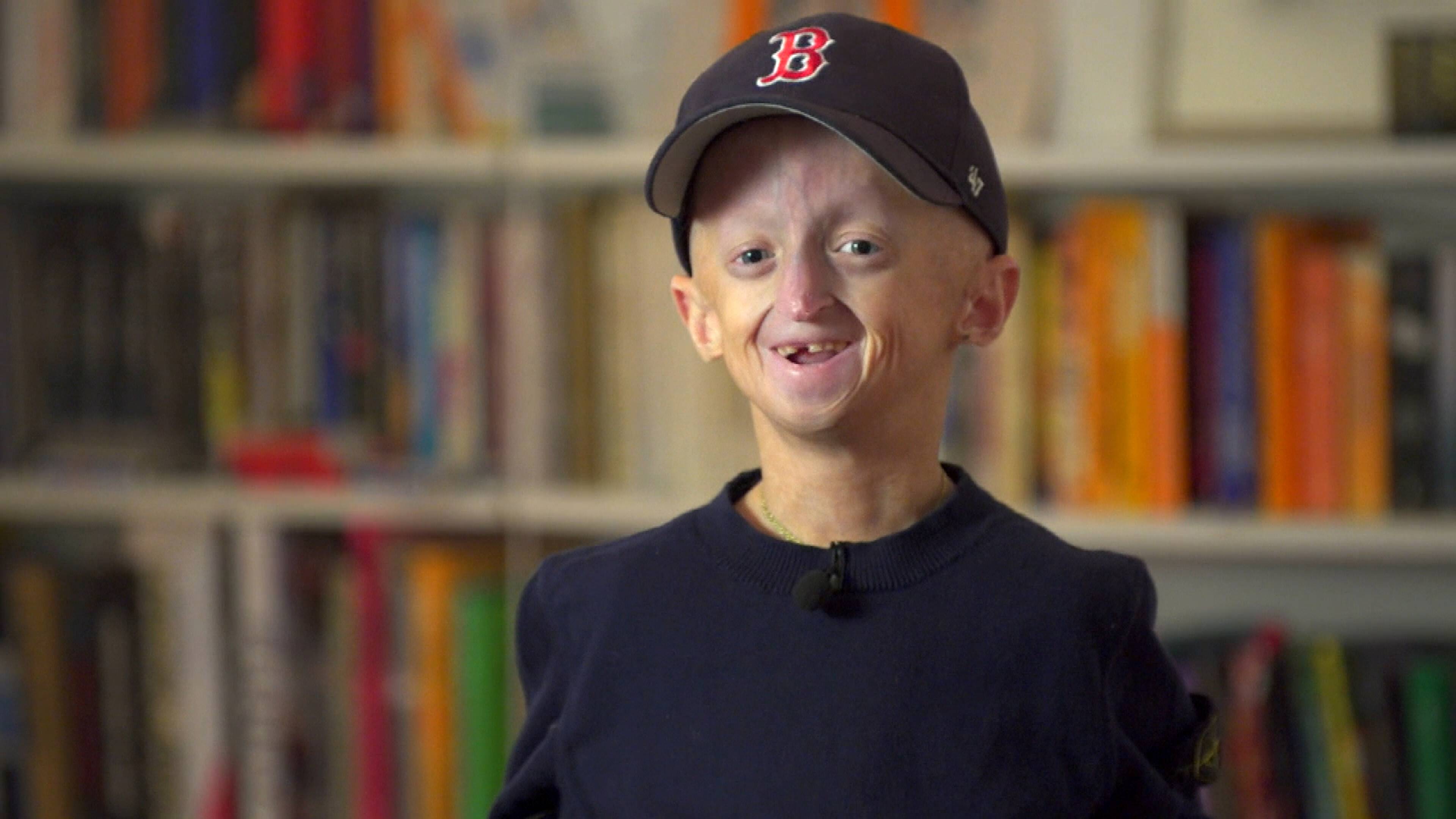 Progeria Kinderen Meet Sammy: The 22 Year Old Who Looks Like An Old