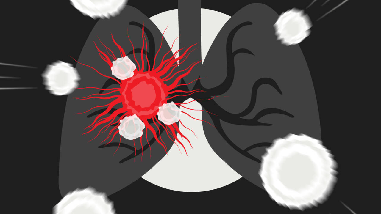 'Veelbelovende resultaten' bij nieuwe behandeling alvleesklierkanker | NOS