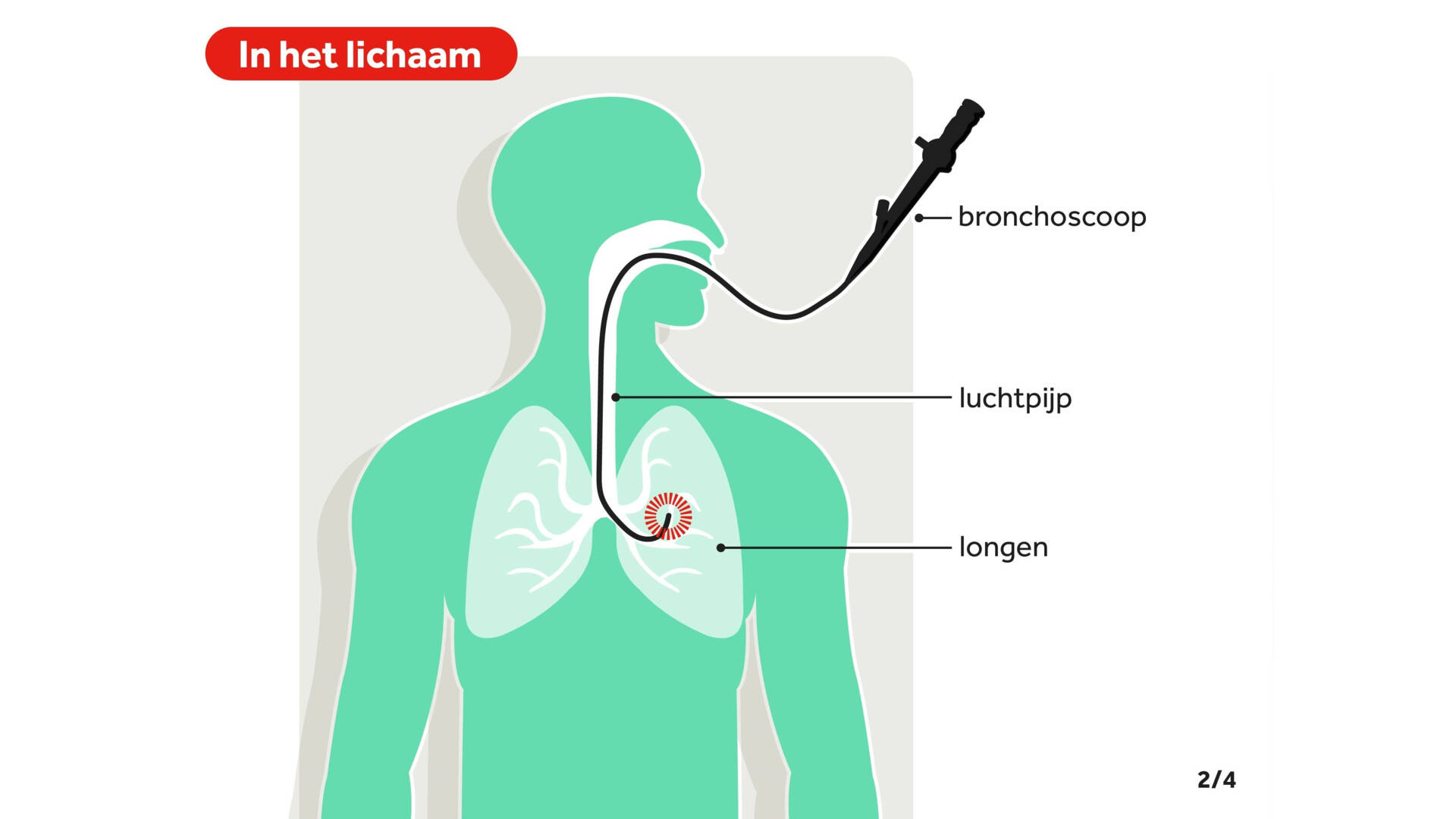 Betere methode Radboudumc om longkanker vroegtijdig op te sporen | NOS