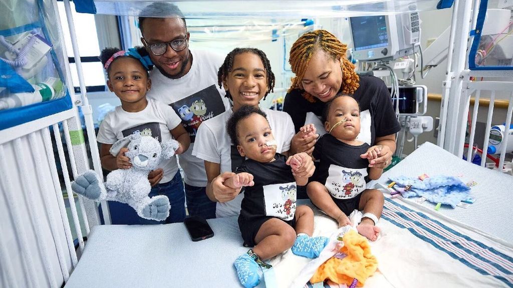 Siamese tweeling succesvol van elkaar los gemaakt